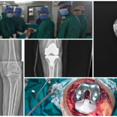 Left Knee Osteoarthritis Grade 4 Treated with Total Knee Replacement ...