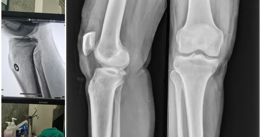 Right PCL Avulsion Fracture Treated with PCL Avulsion Fixation ...