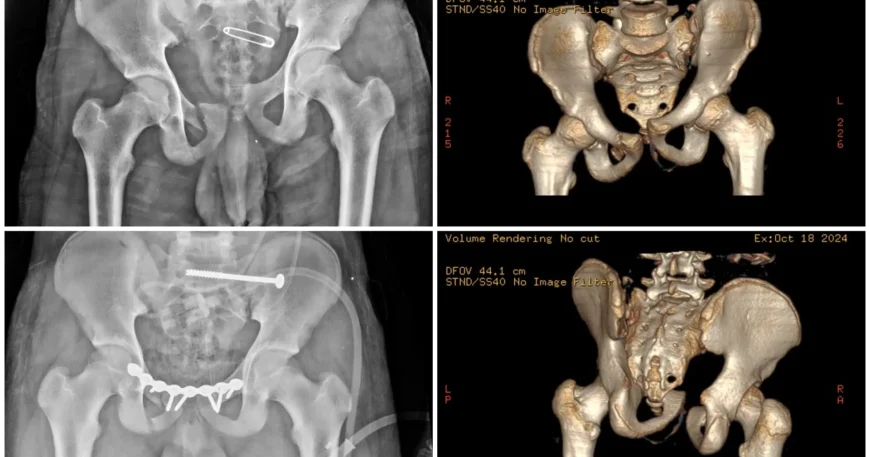 Right Pelvic Ring Fracture (Young–Burgess Vertical Shear) Treated with ...