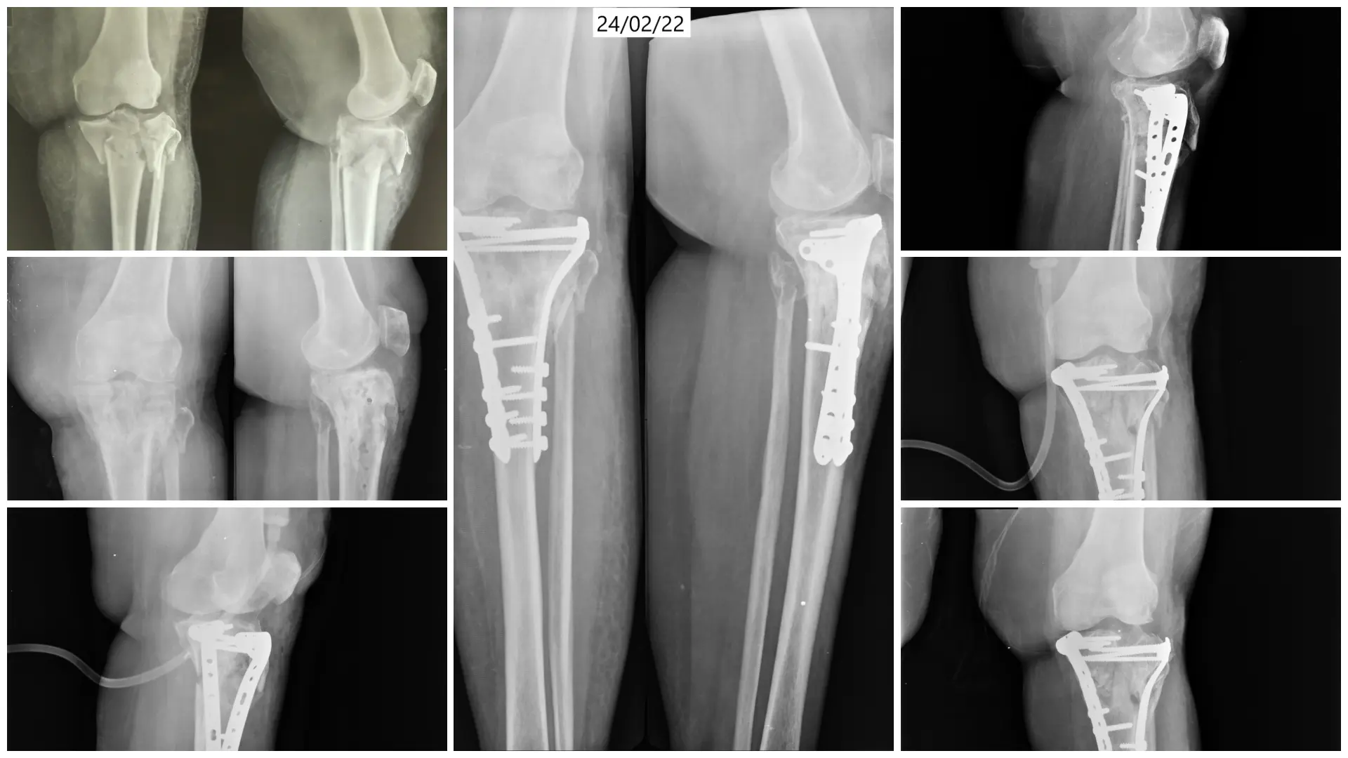 Right Proximal Tibia Fracture Surgery with Bicolumnar Plates | Balanku ...